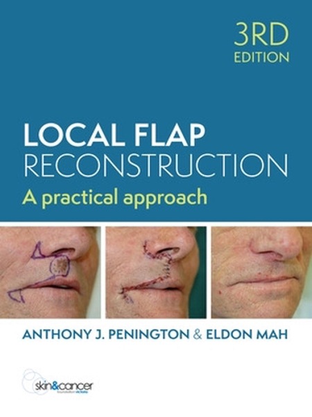 Buy Local Flap Reconstruction - MyDeal Australia